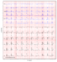 ECG interpretation: Characteristics of the normal ECG (P-wave, QRS ...