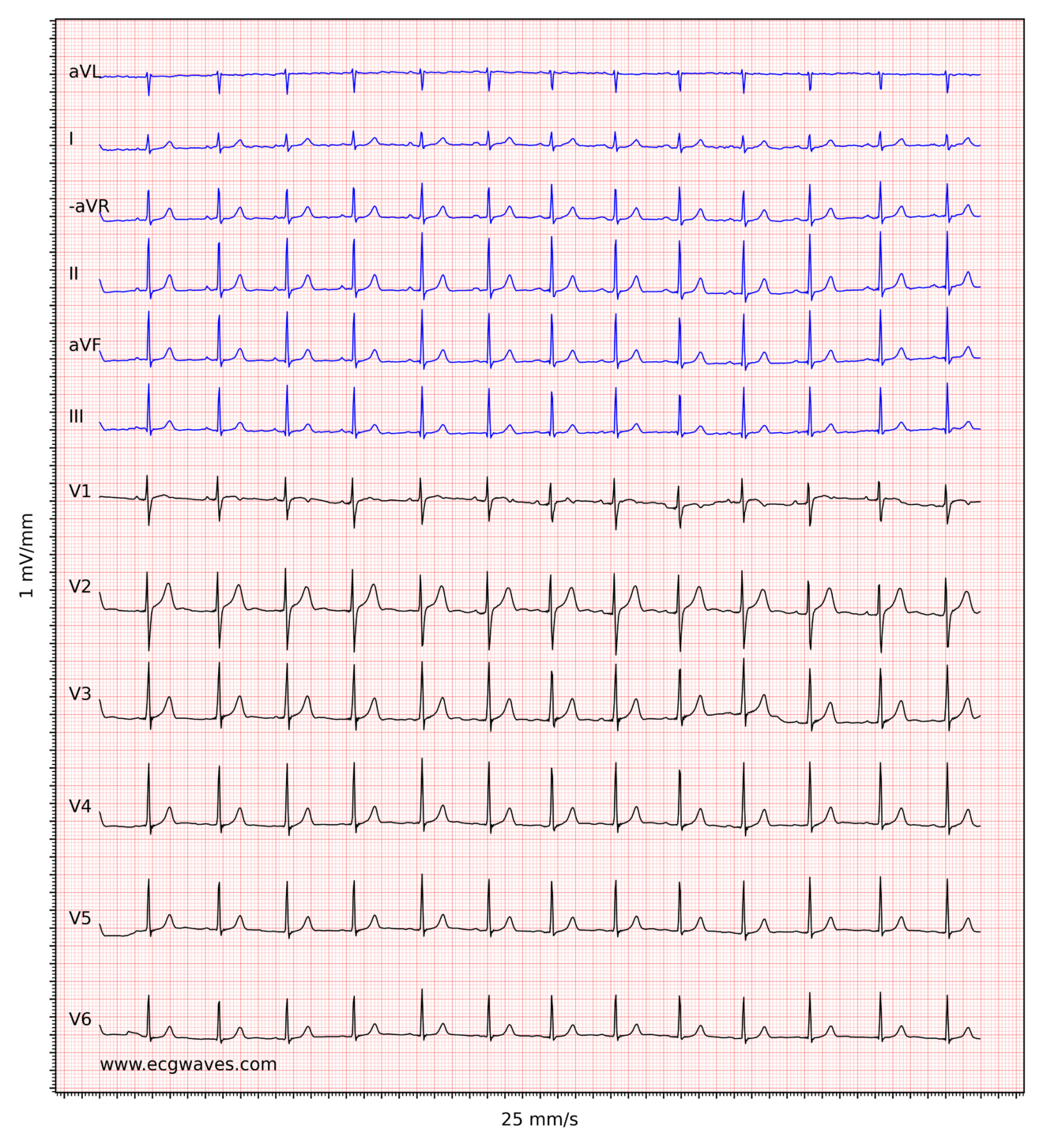 ECG interpretation: Characteristics of the normal ECG (P-wave, QRS ...
