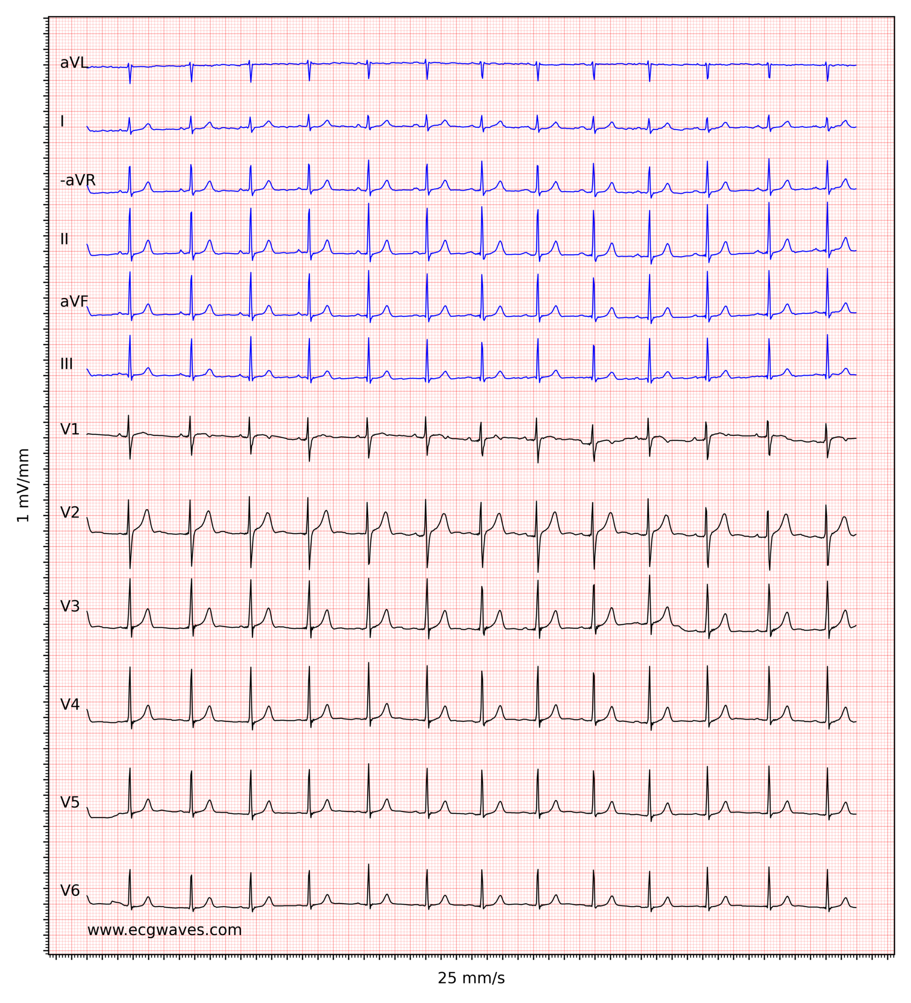 ECG interpretation: Characteristics of the normal ECG (P-wave, QRS ...