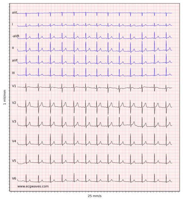 ECG example 1. Normal sinus rhythm. – The Cardiovascular