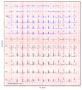 ECG interpretation: Characteristics of the normal ECG (P-wave, QRS ...