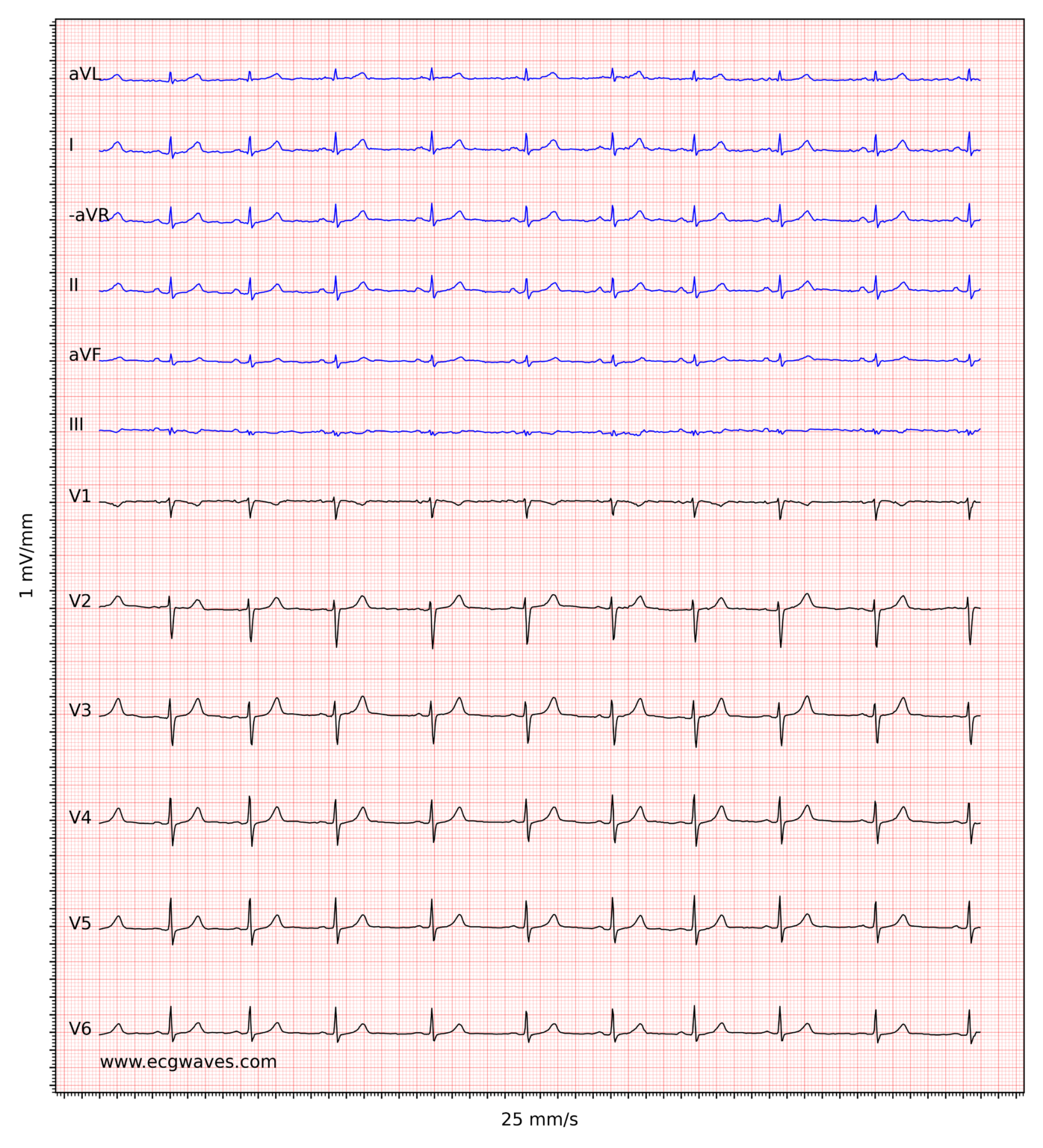 ECG interpretation: Characteristics of the normal ECG (P-wave, QRS ...
