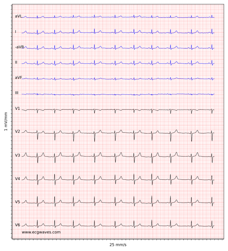 ECG interpretation: Characteristics of the normal ECG (P-wave, QRS ...