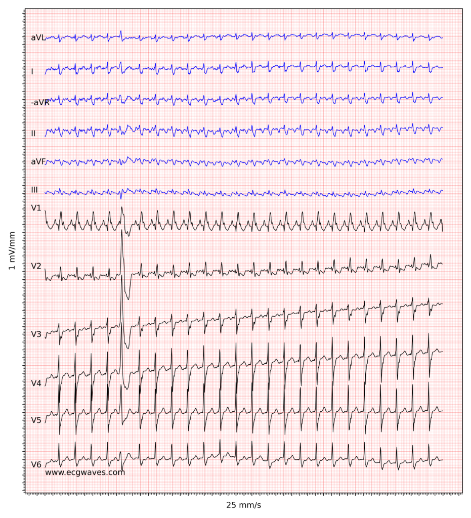 ECG-example-atrial-flutter-1 – The Cardiovascular