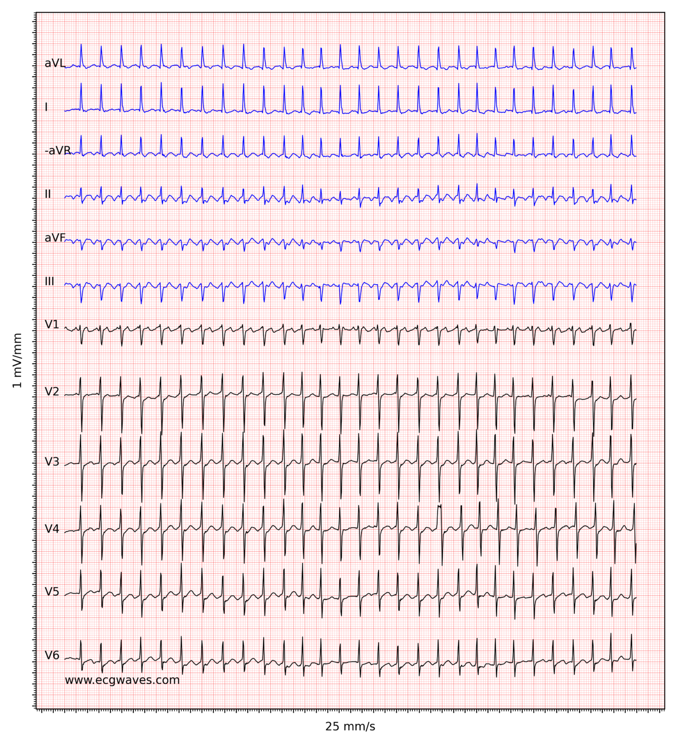 Atrial Flutter Classification Causes Ecg Diagnosis And Management