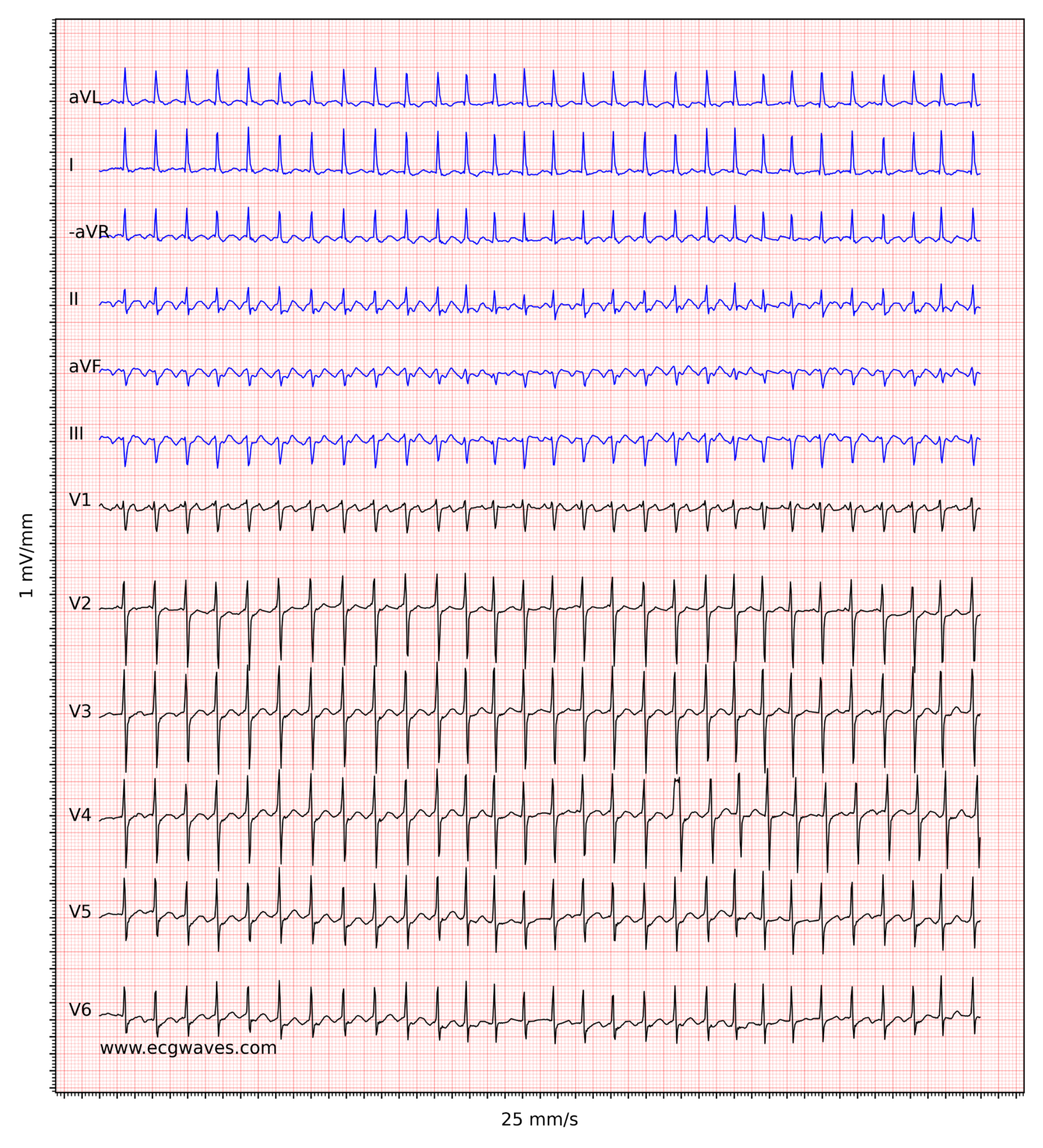 Atrial flutter: classification, causes, ECG diagnosis & management