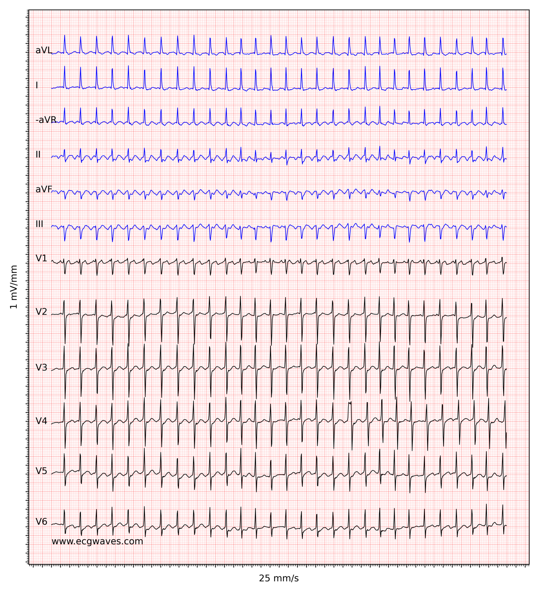 Atrial flutter: classification, causes, ECG diagnosis & management