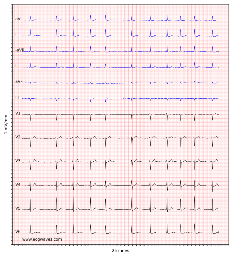 ECG-non-specific-ST-depression-atrial-fibrillation-digitalis-effect-non ...