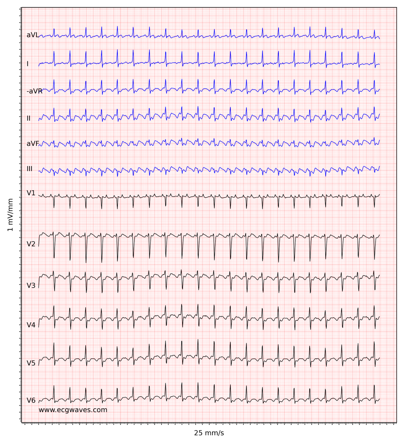 Atrial flutter: classification, causes, ECG diagnosis & management