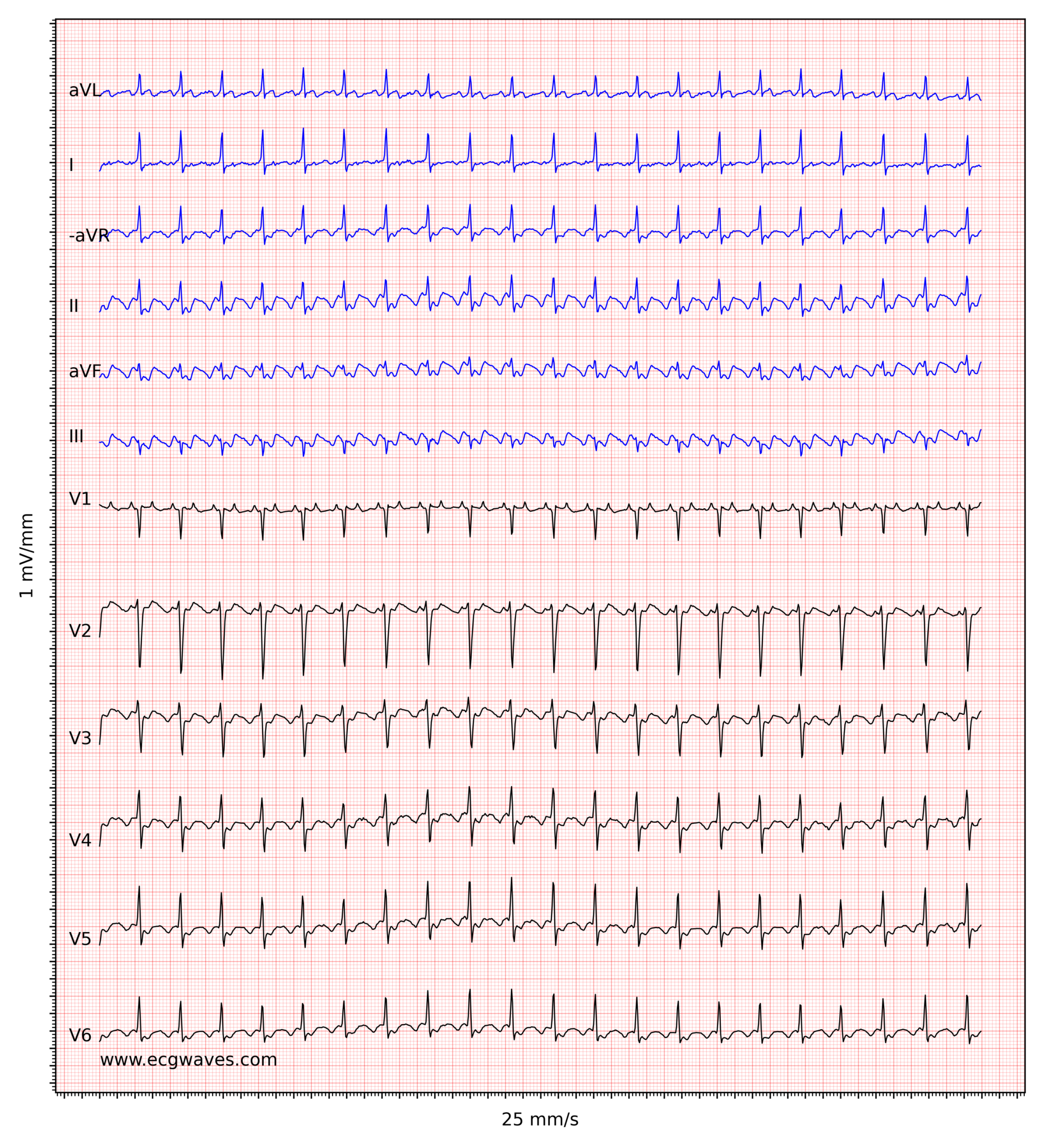Atrial flutter: classification, causes, ECG diagnosis & management