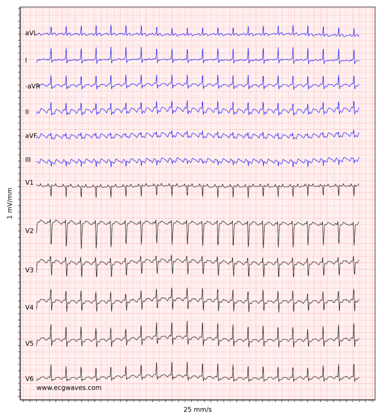 Atrial flutter: classification, causes, ECG diagnosis & management