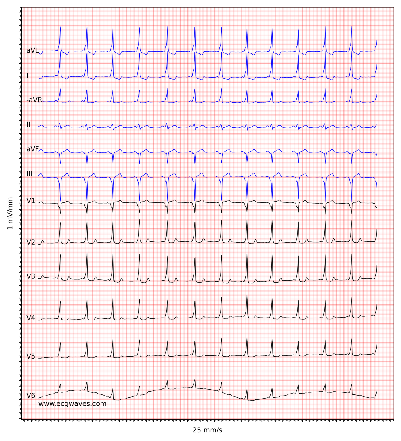Pre-excitation, Atrioventricular Reentrant (Reentry) Tachycardia (AVRT ...