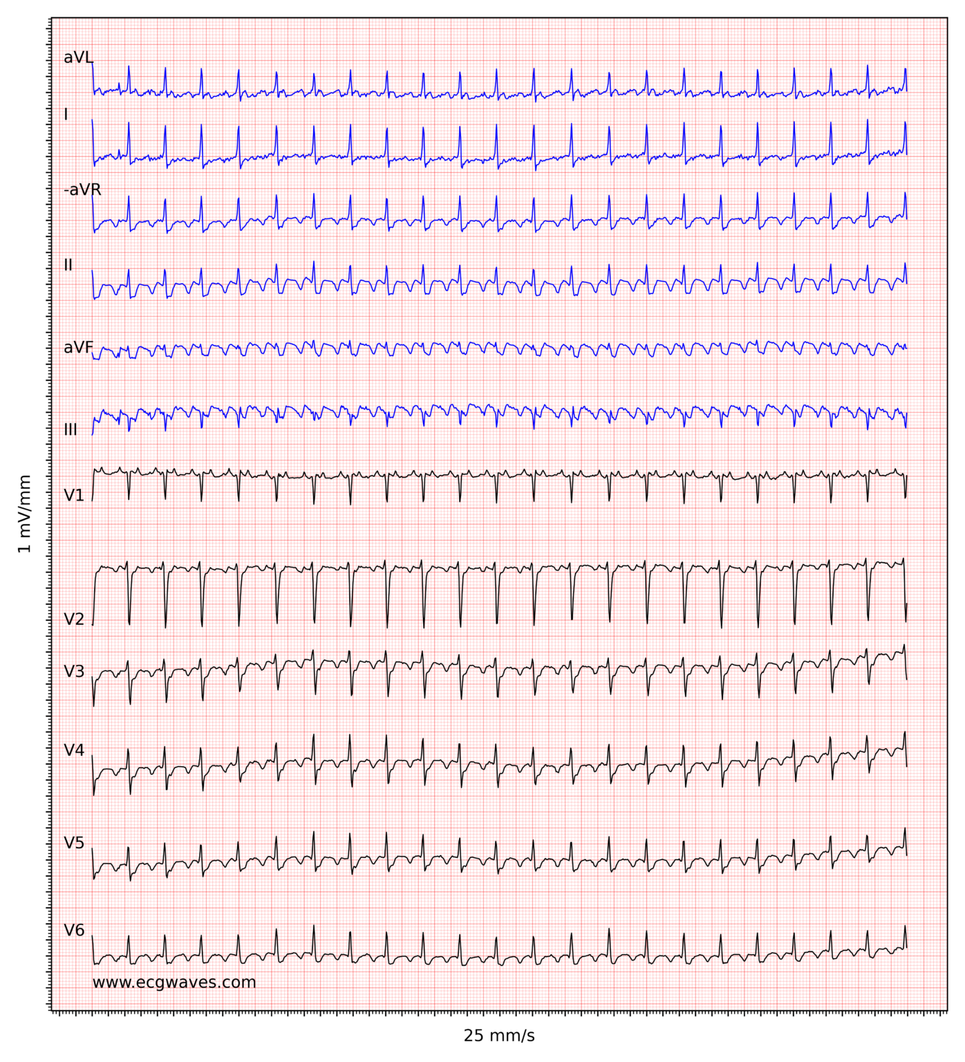 Atrial flutter, various examples – The Cardiovascular