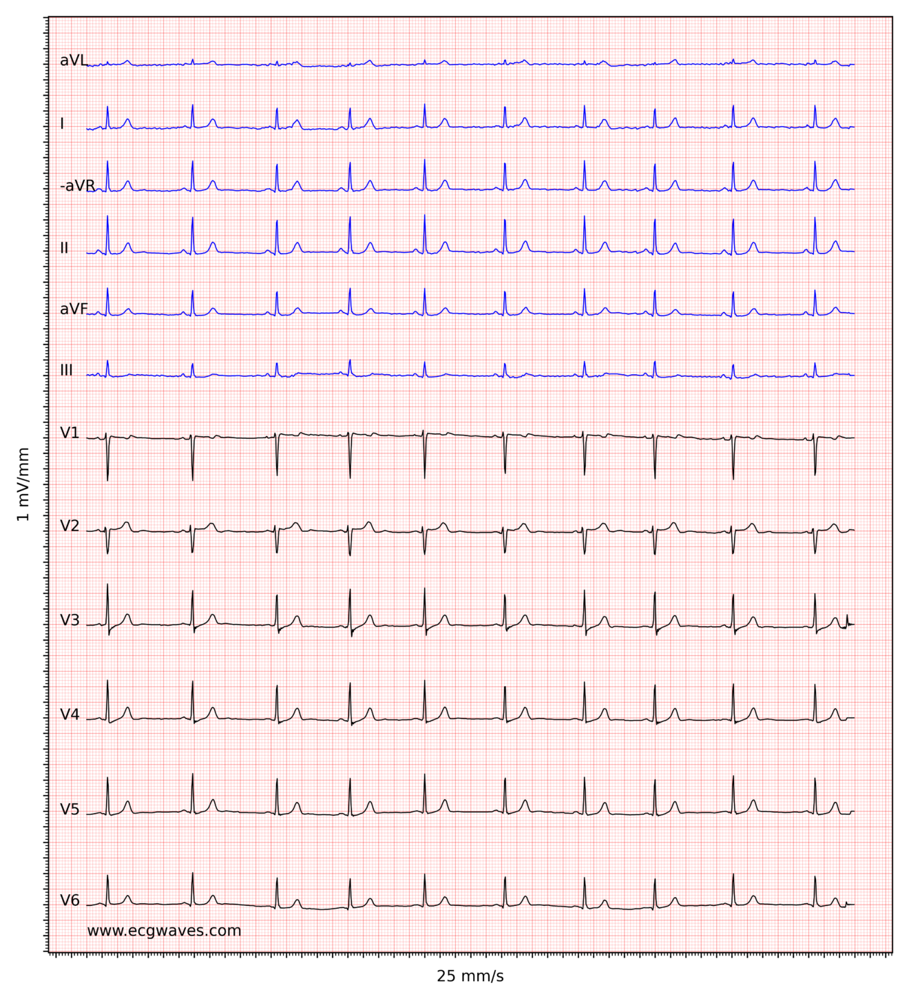 ECG_42_ecg_id-42-normal-ECG-sinus-rhythm – The Cardiovascular