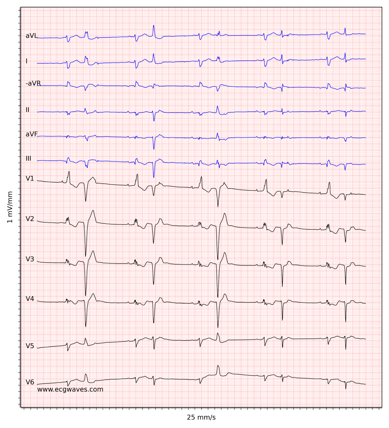 atrial fibrillation, ventricular premature complex, complete right ...