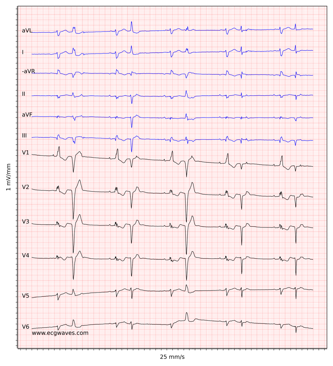 atrial fibrillation, ventricular premature complex, complete right ...