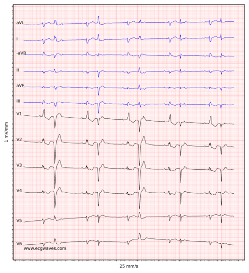 atrial fibrillation, ventricular premature complex, complete right ...