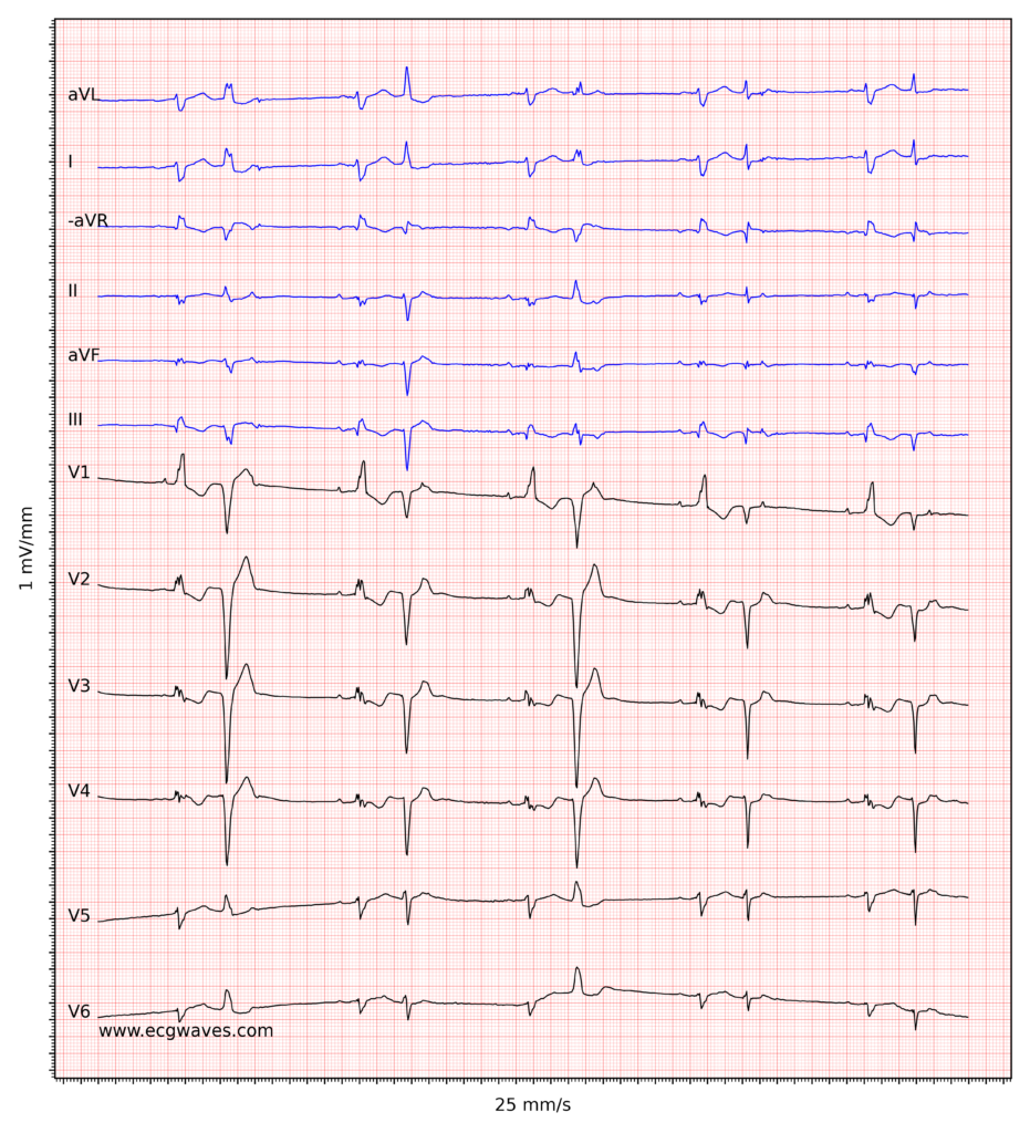atrial fibrillation, ventricular premature complex, complete right ...