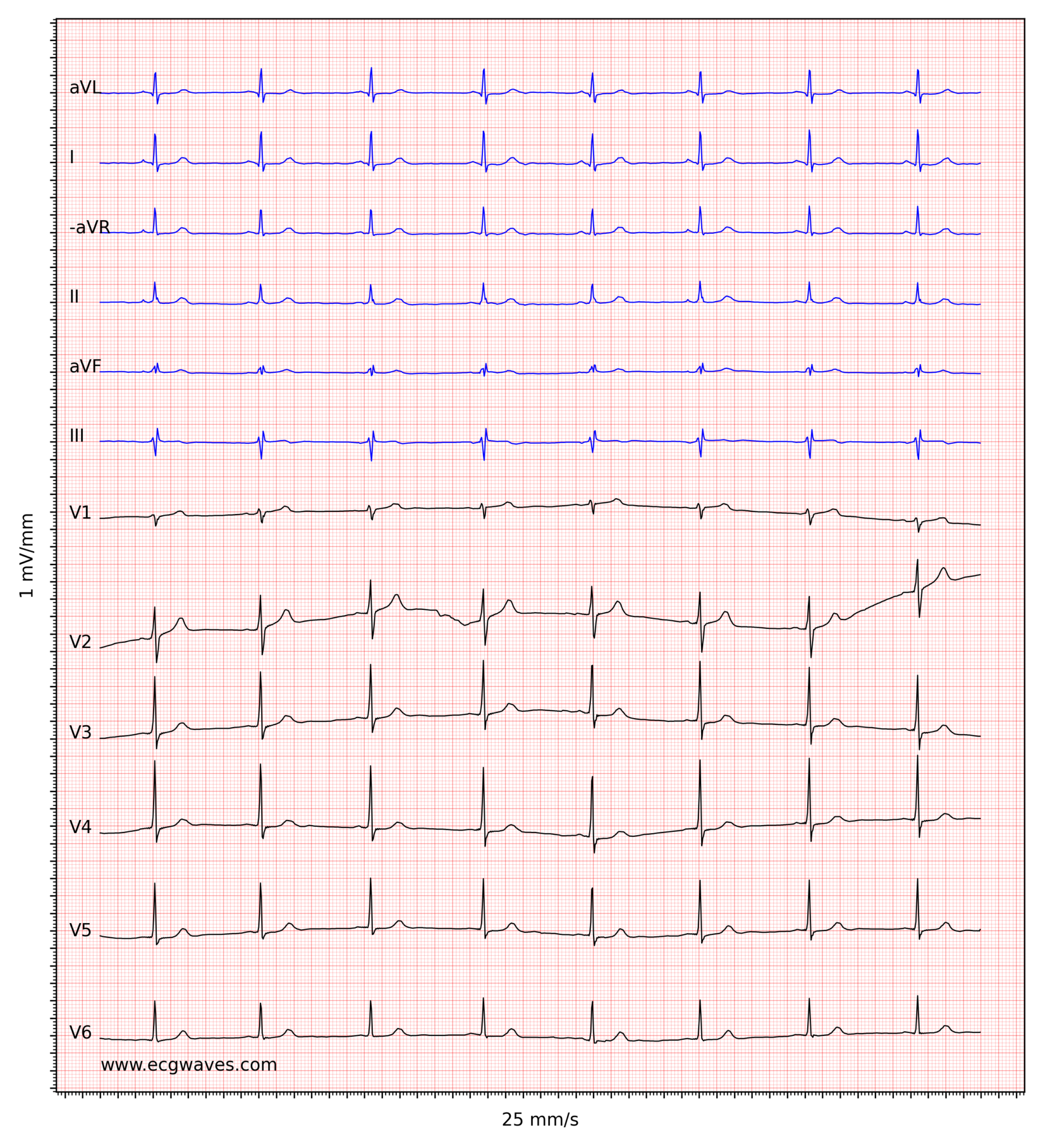 Sinus bradycardia: definitions, ECG, causes and management