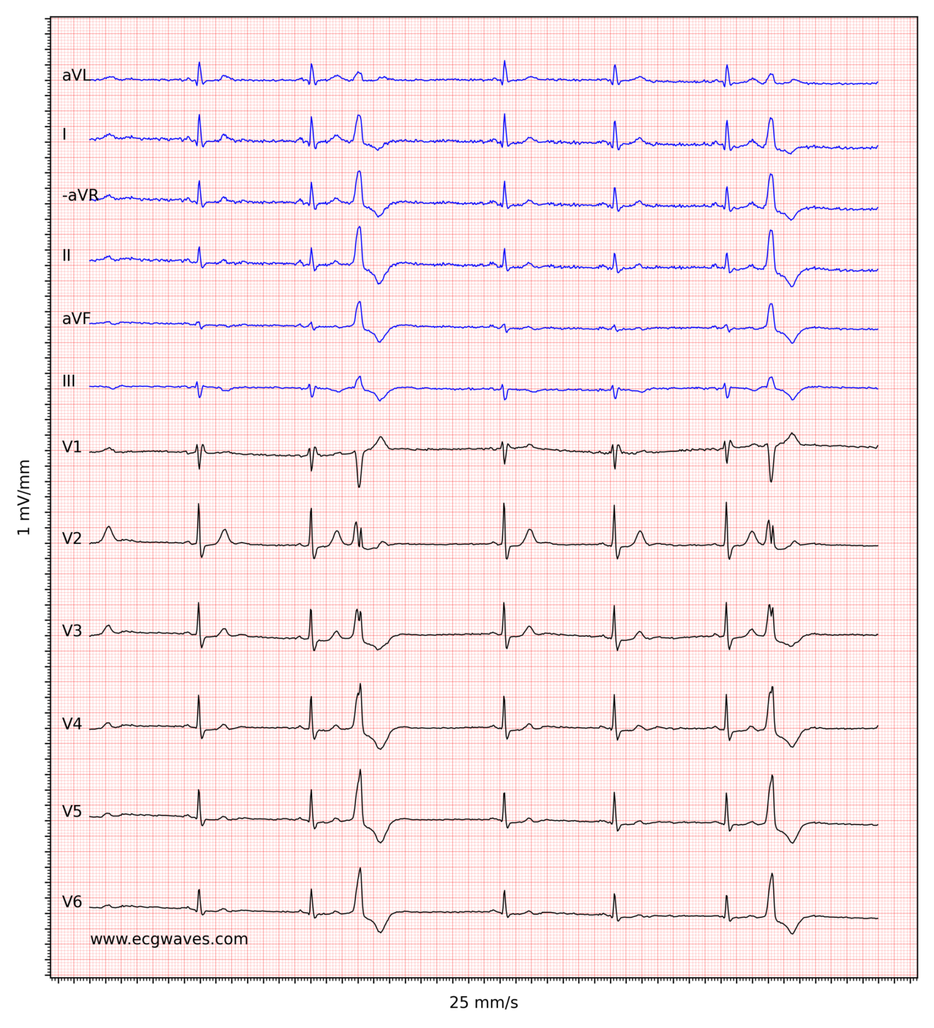 Sinus bradycardia: definitions, ECG, causes and management