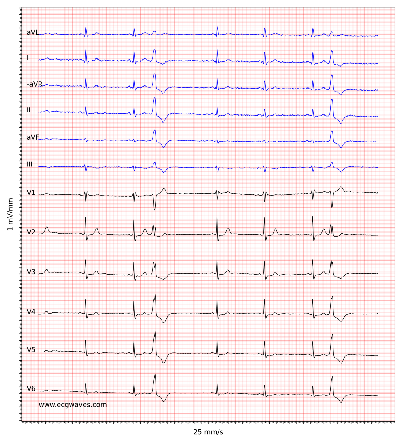 Sinus bradycardia: definitions, ECG, causes and management