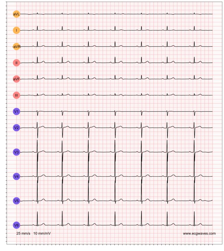 First-degree AV block (AV block I, AV block 1)