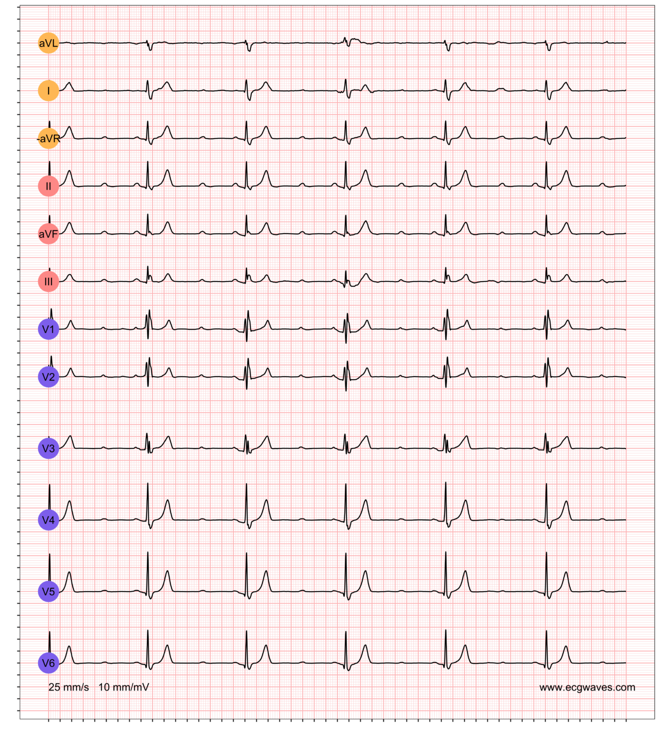 Second-degree AV block: Mobitz type 1 (Wenckebach) & Mobitz type 2 block