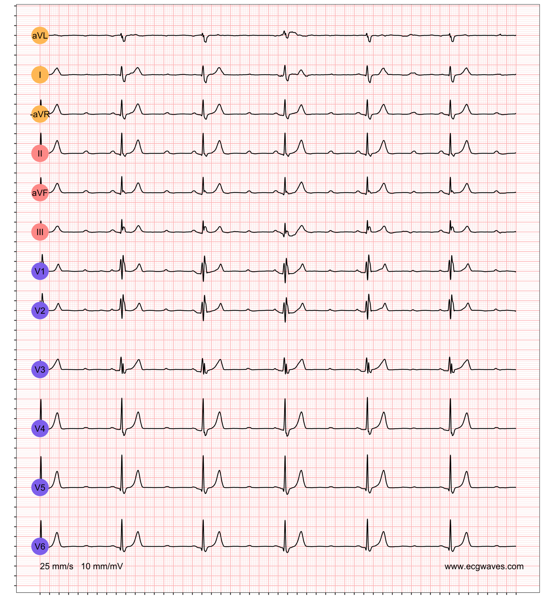 Second-degree AV block: Mobitz type 1 (Wenckebach) & Mobitz type 2 block