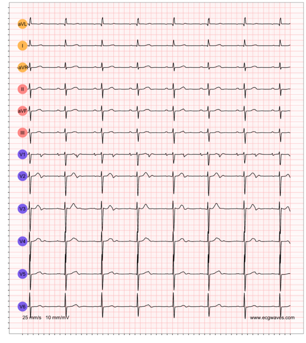 Second-degree AV block: Mobitz type 1 (Wenckebach) & Mobitz type 2 block