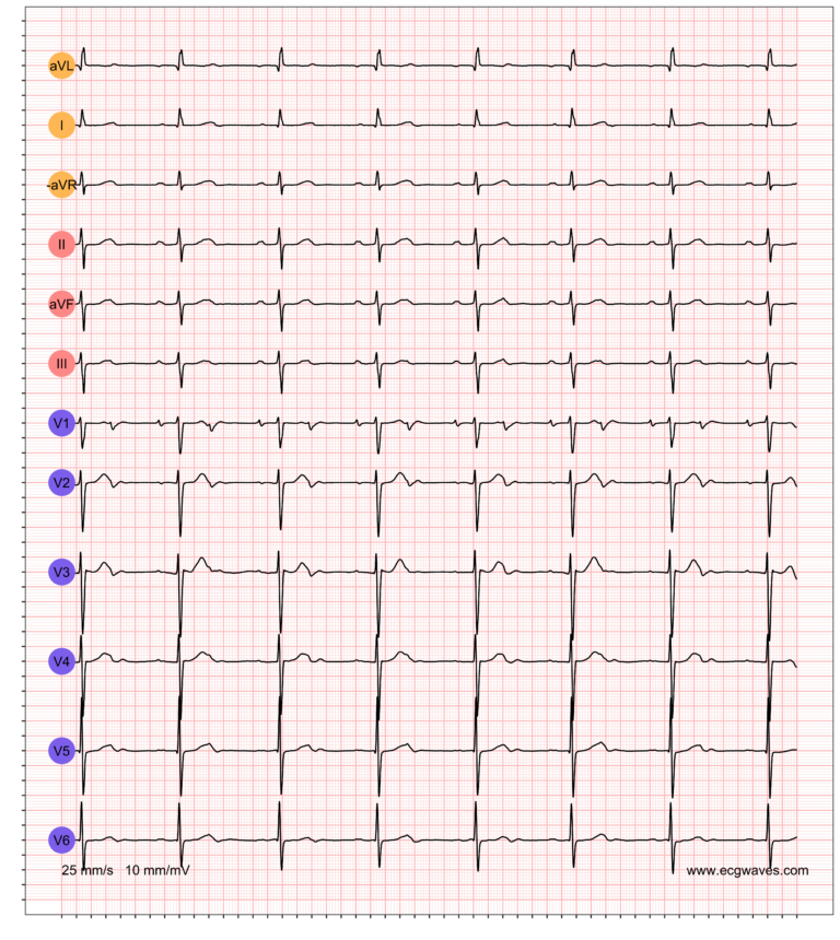 Second-degree AV block: Mobitz type 1 (Wenckebach) & Mobitz type 2 block