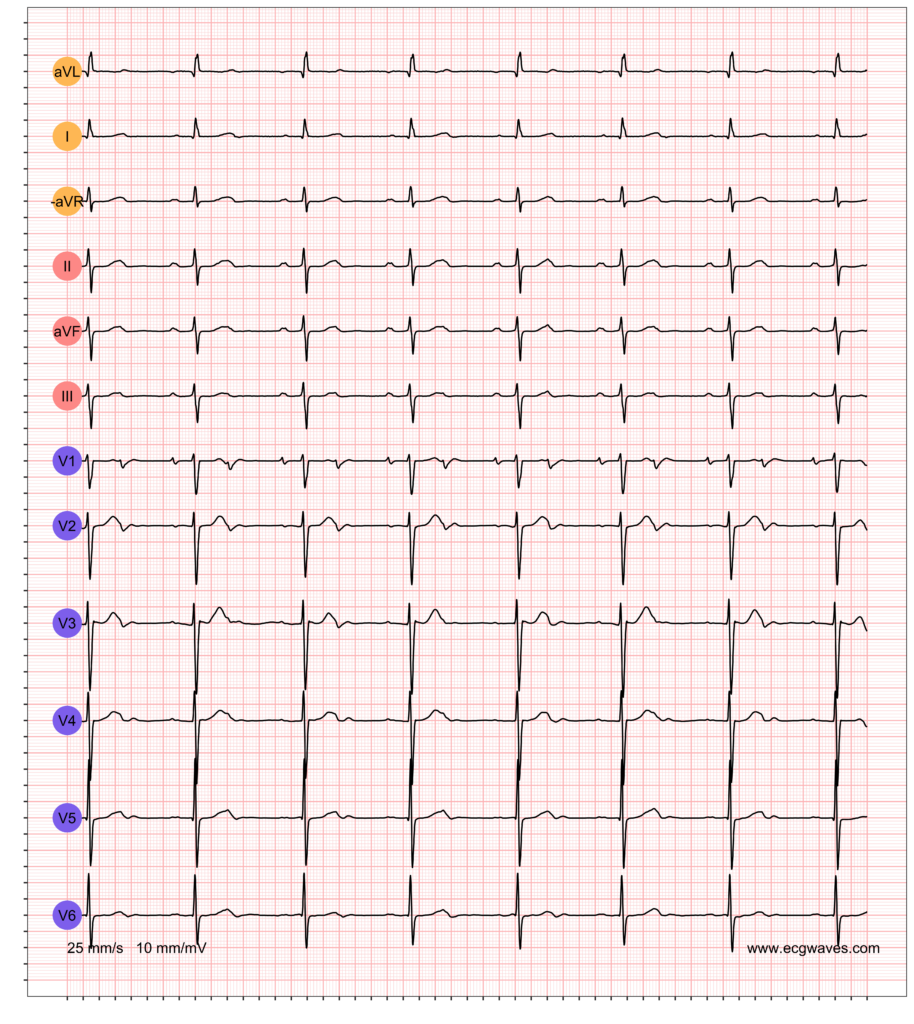Second-degree AV block: Mobitz type 1 (Wenckebach) & Mobitz type 2 block