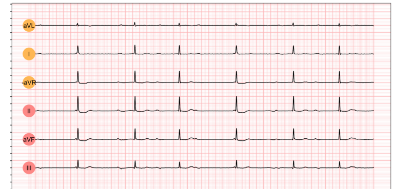 Third-degree AV block (3rd degree AV block, AV block 3, AV block III)