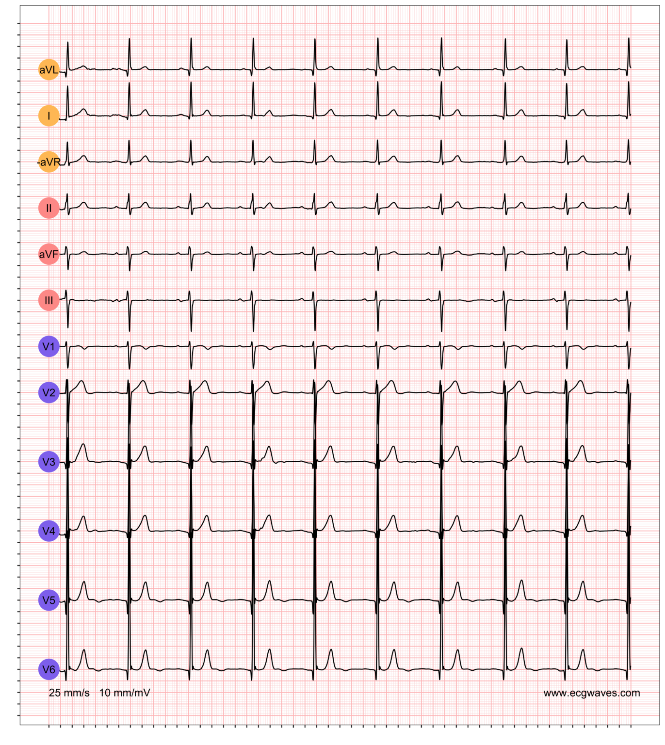First-degree AV block (AV block I, AV block 1)