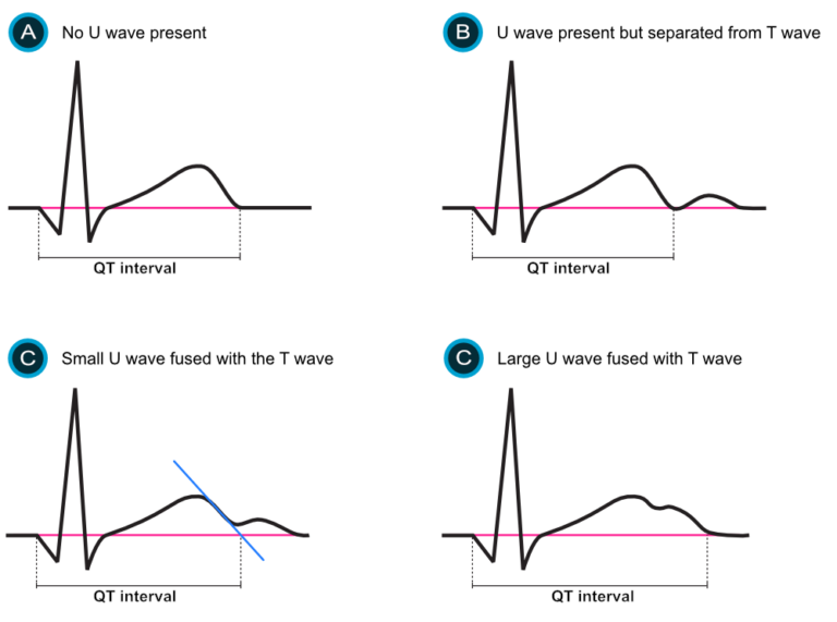 how-to-measure-qt-qtc-interval-on-ecg – The Cardiovascular