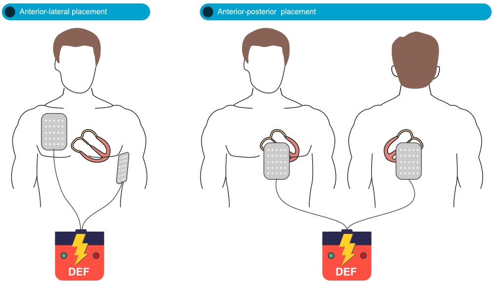 Advanced Cardiopulmonary Resuscitation CPR Advanced Cardiovascular