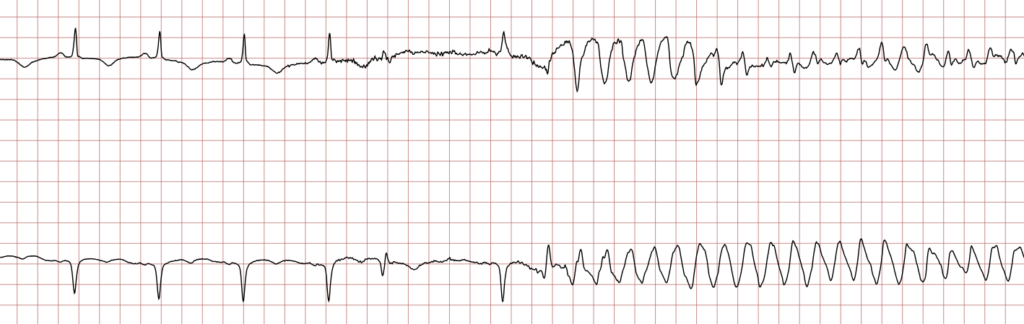 Ventricular tachycardia (VT): ECG criteria, causes, classification ...