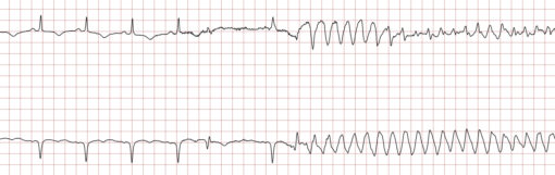 Ventricular fibrillation, pulseless electrical activity and sudden ...
