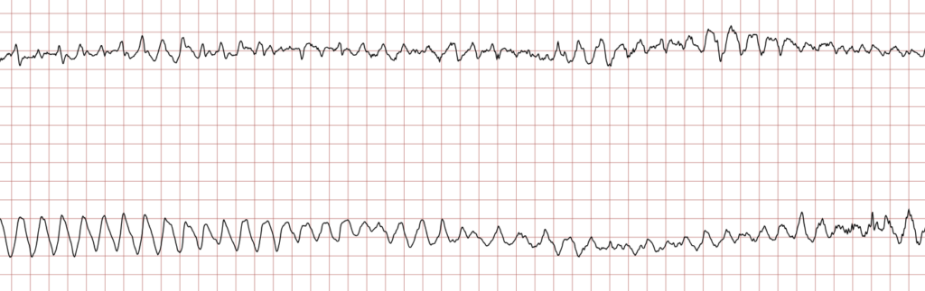 Ventricular tachycardia (VT): ECG criteria, causes, classification ...