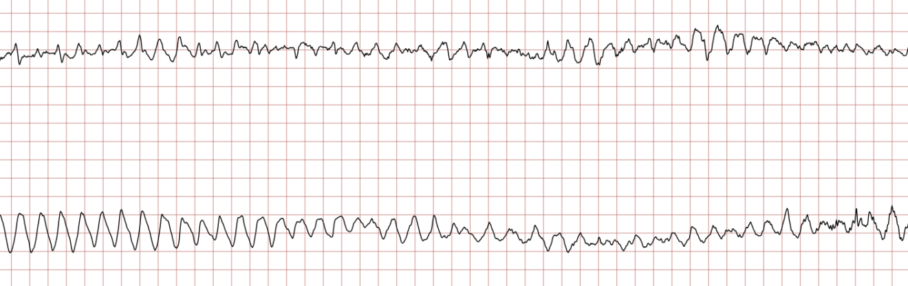 Ventricular tachycardia (VT): ECG criteria, causes, classification ...