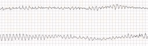 Ventricular fibrillation, pulseless electrical activity and sudden ...