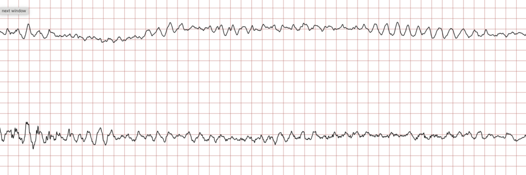 Ventricular tachycardia (VT): ECG criteria, causes, classification ...