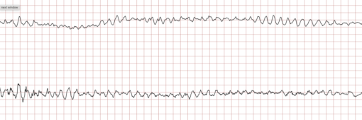 Ventricular tachycardia (VT): ECG criteria, causes, classification ...