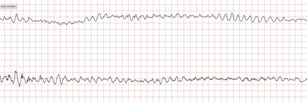 Ventricular tachycardia (VT): ECG criteria, causes, classification ...