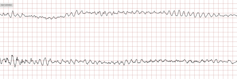 Ventricular tachycardia (VT): ECG criteria, causes, classification ...