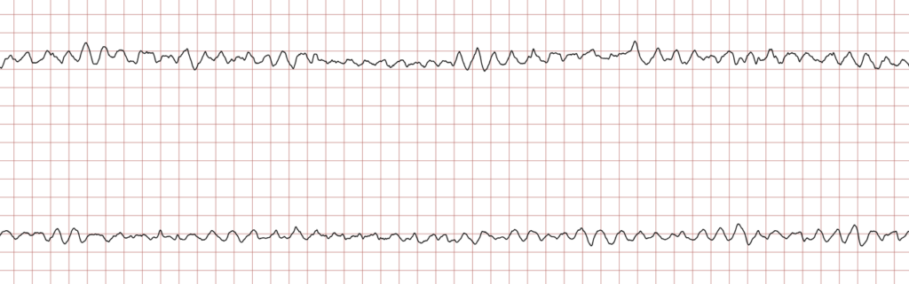 Ventricular tachycardia (VT): ECG criteria, causes, classification ...