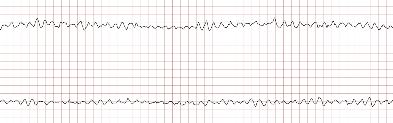 Ventricular tachycardia (VT): ECG criteria, causes, classification ...