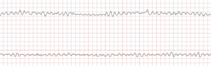 Ventricular tachycardia (VT): ECG criteria, causes, classification ...