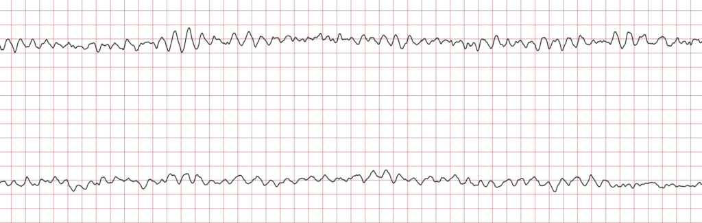 Ventricular tachycardia (VT): ECG criteria, causes, classification ...