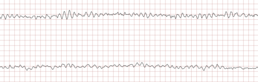 Ventricular tachycardia (VT): ECG criteria, causes, classification ...
