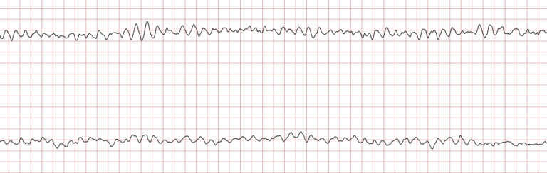 Ventricular tachycardia (VT): ECG criteria, causes, classification ...